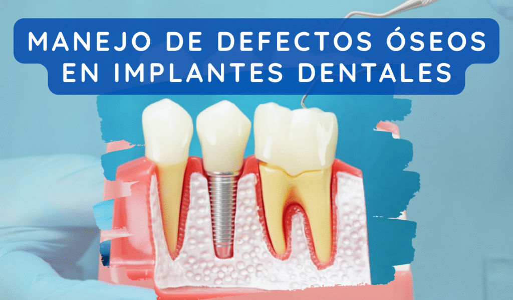 Manejo de defectos óseos en Implantes Dentales – Especialistas